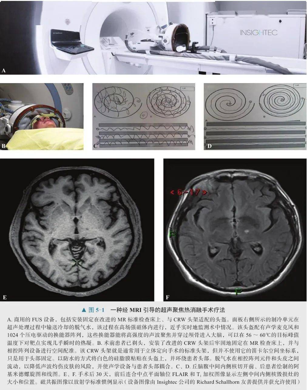 新书推介 《脑深部电刺激：技术与实践》治疗