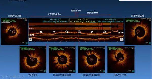 Safety Gained 充分预处理专题 | OCT指导下应用NSE棘突球囊治疗ISR一例-搜狐大视野-搜狐新闻