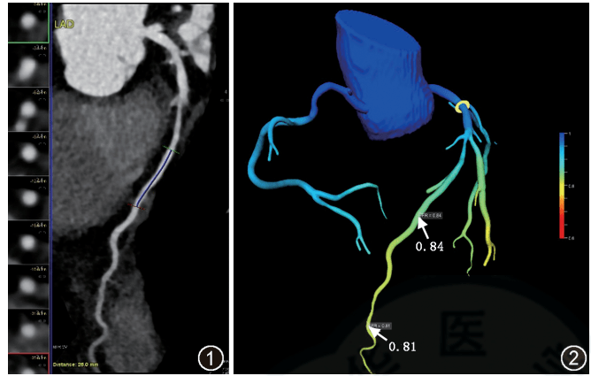 该不该放支架，可使用这一技术来评价！冠脉CT-FFR中国专家建议_病变