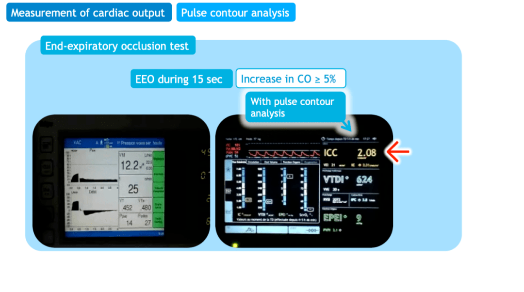 PiCCO在ICU中的应用_进行