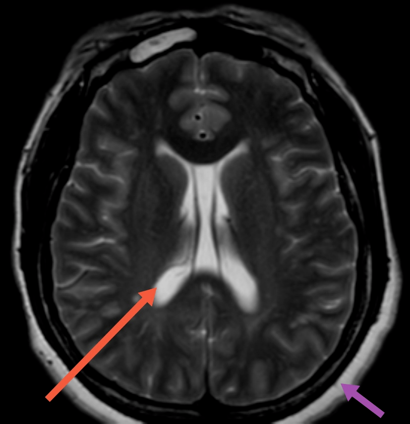 FSE序列上短T2的脂肪为何表现为高信号_耦合