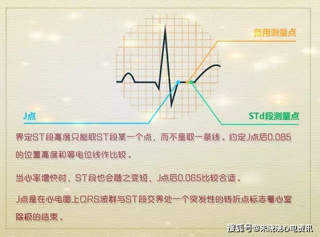 简单4个步骤，读懂ST-T段改变特点！_电位