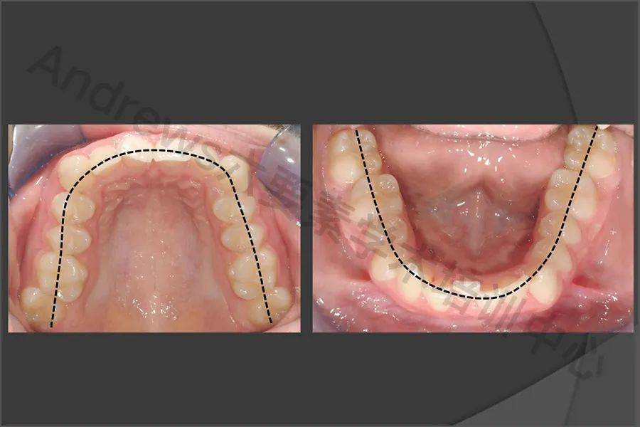 何为“WALA嵴”？有何临床意义？_Andrews_下颌_宽度