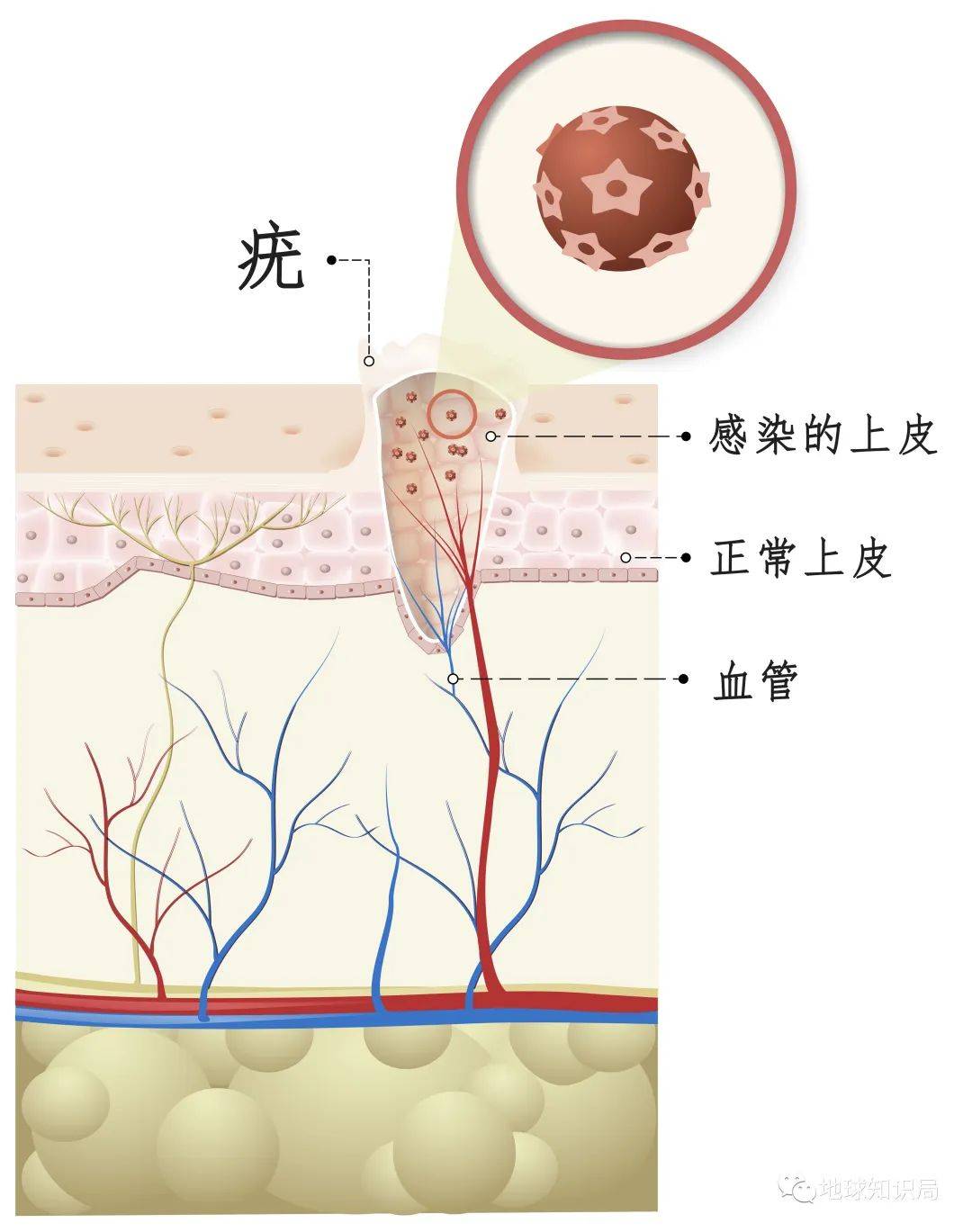 尖锐湿疣,不只是长菜花 地球知识局疾病生殖器蟾蜍
