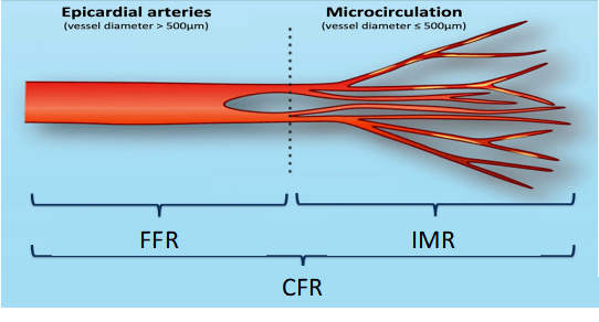 “心”技术| caFFR和caIMR开启冠心病精准介入诊疗 的“心时代”！_李先生_冠状动脉_症状