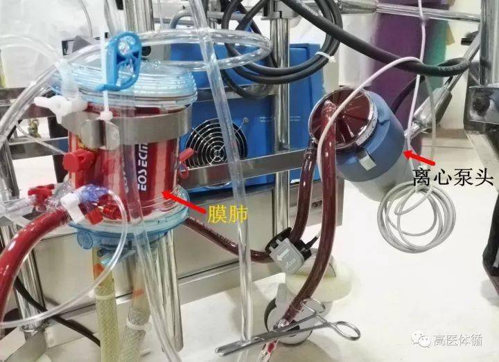 重症患者“最后的救命稻草”——ECMO详细解读_插管