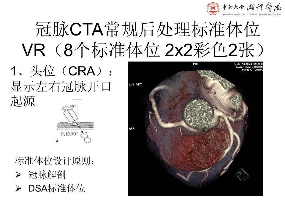 湘雅医院冠脉CTA标准化图像后处理及规范化诊断报告书写-搜狐大视野-搜狐新闻
