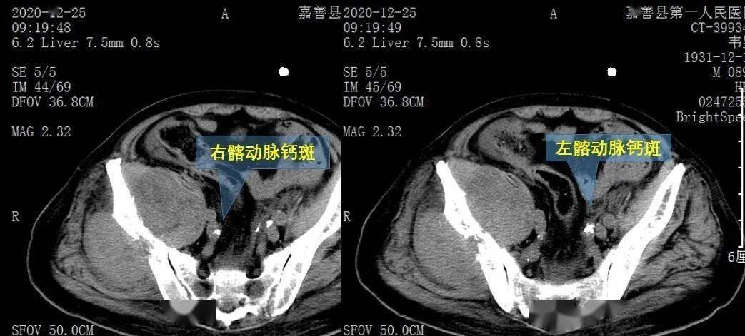 可调控微导管 | 联合D-TACE +HAIC 为91岁肝癌骨转移老人成功介入手术_动脉
