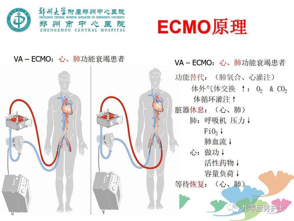 ECMO患者如何护理，这几点重点提示你一定要看看_治疗