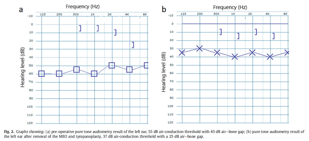 Middle ear osteoma causing Eustachian tube obstruction_is