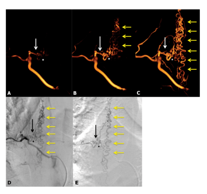 JNIS中文版丨邓剑平教授导读：4D-DSA在脊髓血管畸形诊治中应用的初步经验_动静脉