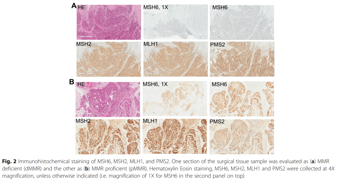 【文章发表】结构性错配修复缺陷综合征(CMMRD)知多少？-- 首次报道CMMRD患者获益于帕博利珠单抗联合瑞戈非尼治疗_high
