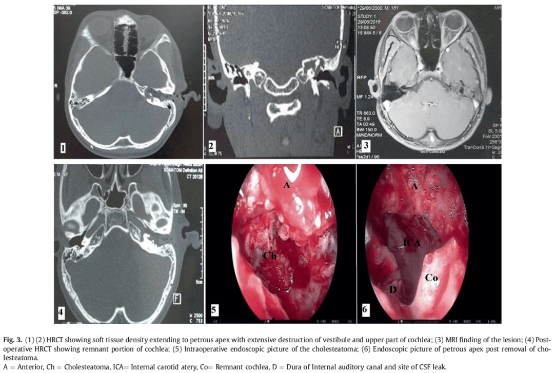 Exclusive endoscopic transcanal approach_The