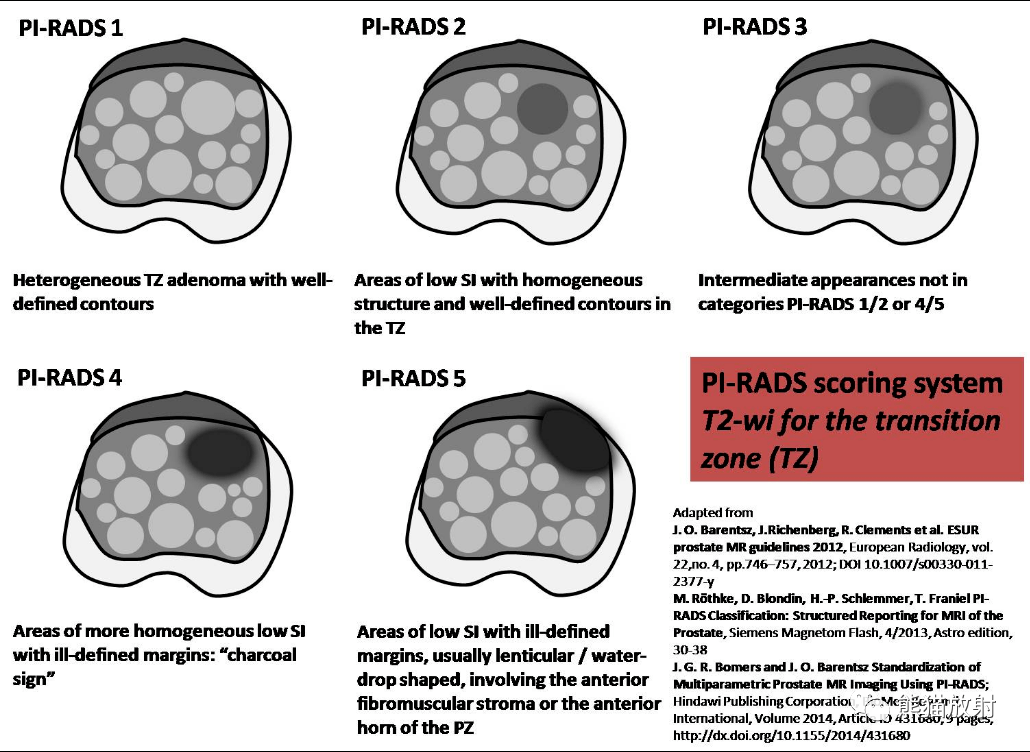 PI-RADS 前列腺影像报告和数据系统_诊断