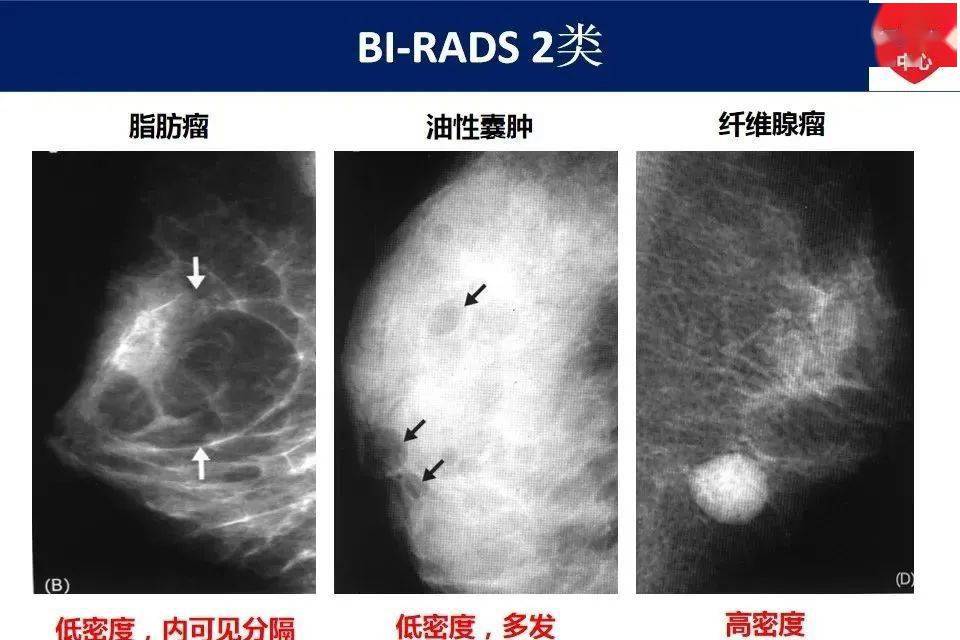 最新版乳腺X线 BI-RADS 分类解读_检查