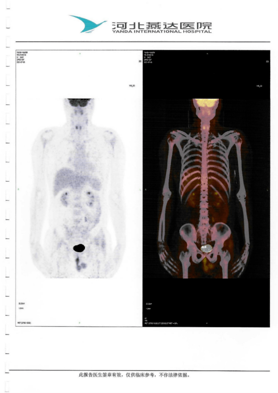 不断突破│陆道培医院 CD7 CAR-T让多病种血液病患者获益_细胞