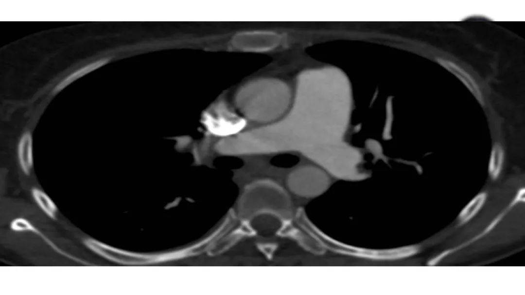 肺肿瘤性血栓性微血管病（PTTM）_患者_肺动脉_栓塞