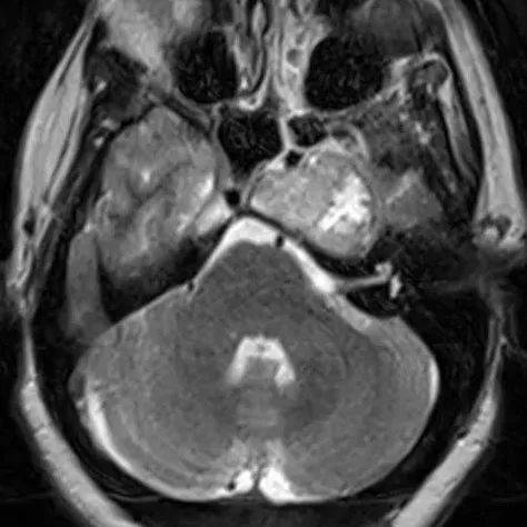 58-year-old woman丨nausea, vomiting_head_mass_the