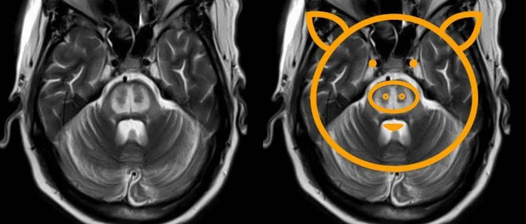 有点意思，“猪鼻征”和“三叉戟征”！_脑桥_中央_患者