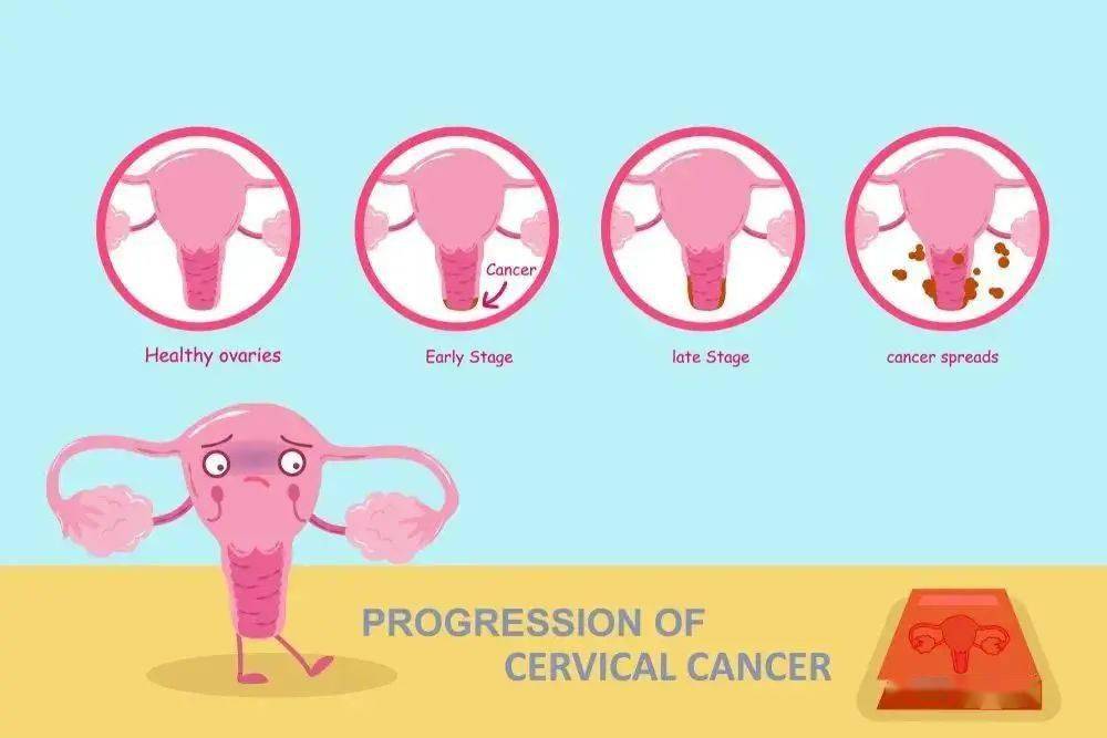 宫颈癌是女性最常见的恶性肿瘤之一,宫颈癌、hpv、tct之间有什么关系?