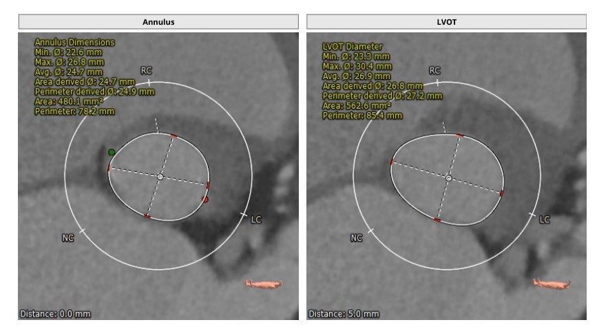 TAVR20年·重庆首例｜陆军军医大学大坪医院心血管内科团队顺利完成ECMO支持下TAVR手术_mmHg_患者_瓣膜