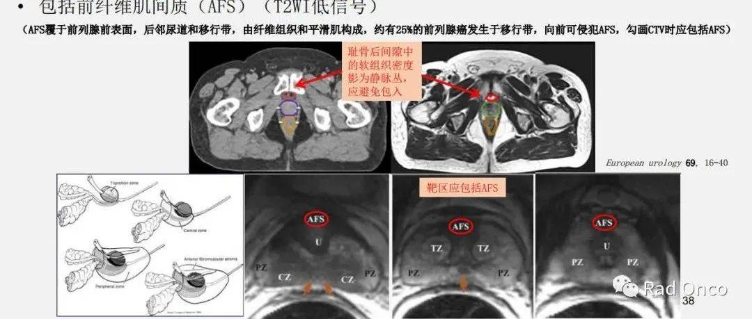 精品课件 | 教学查房之教学解读—局部晚期前列腺癌的放射治疗及靶区勾画_Rad_Onco_来源