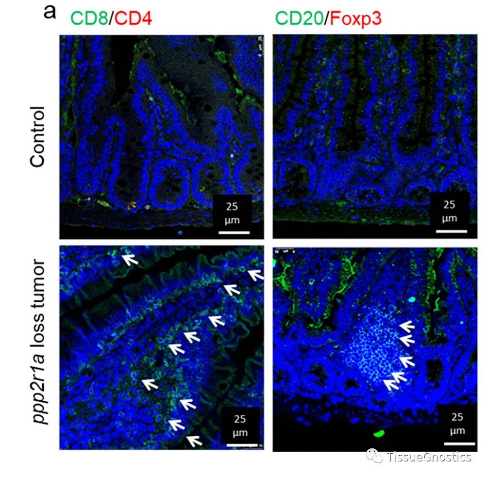 Nature Communications蛋白磷酸酶2A（PP2A）或将成为肿瘤生物标志物“新宠”_体细胞_分析_水平