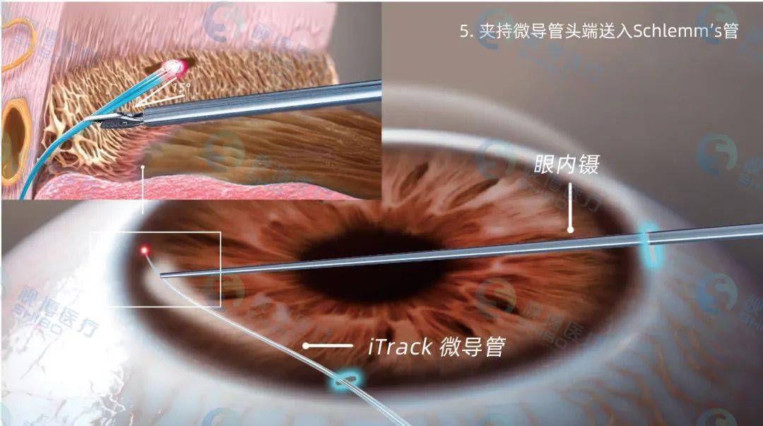 图解： iTrack 内路粘小管成形术（ABiC），一种微创高效的青光眼手术_切口_眼压_导管