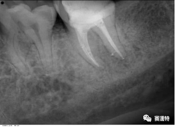 中国锶·C-Root SP：让根管充填如此简单！_口腔_效果_硅酸盐