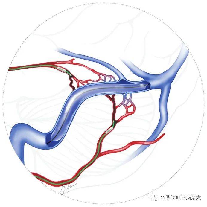【综述】硬脑膜动静脉瘘病因及其发病机制的研究进展_患者_女性_血栓