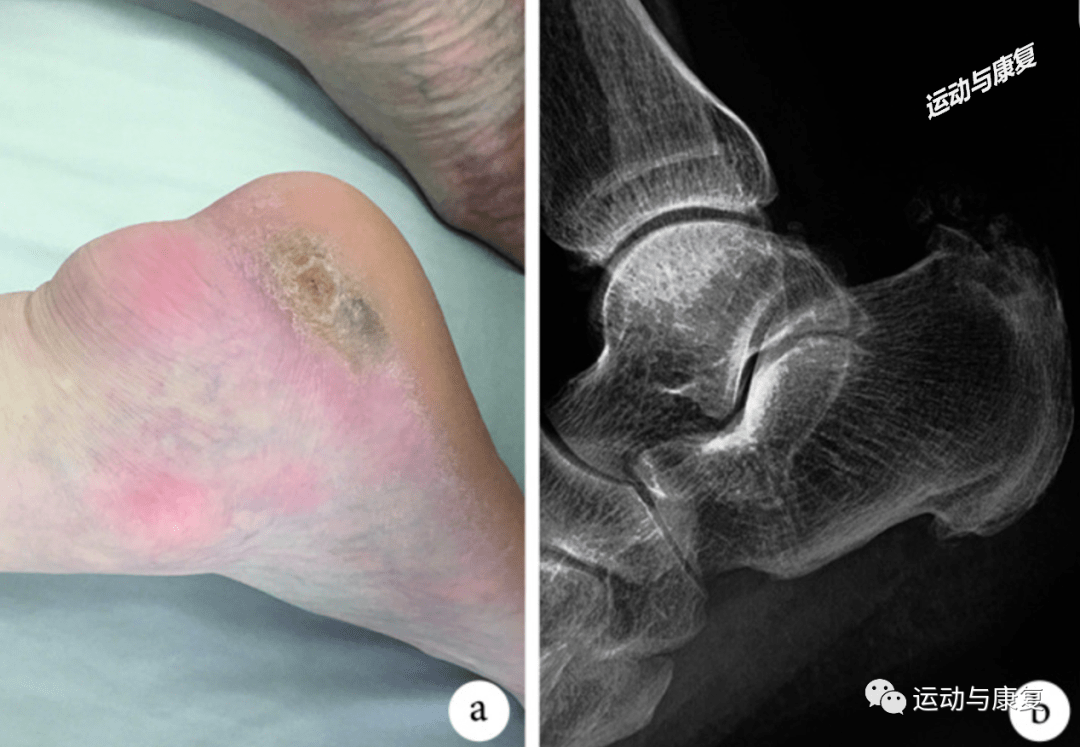 哈格伦德综合征（Haglund's Disease) – 跑者的恶梦_畸形_脚后跟_鞋子