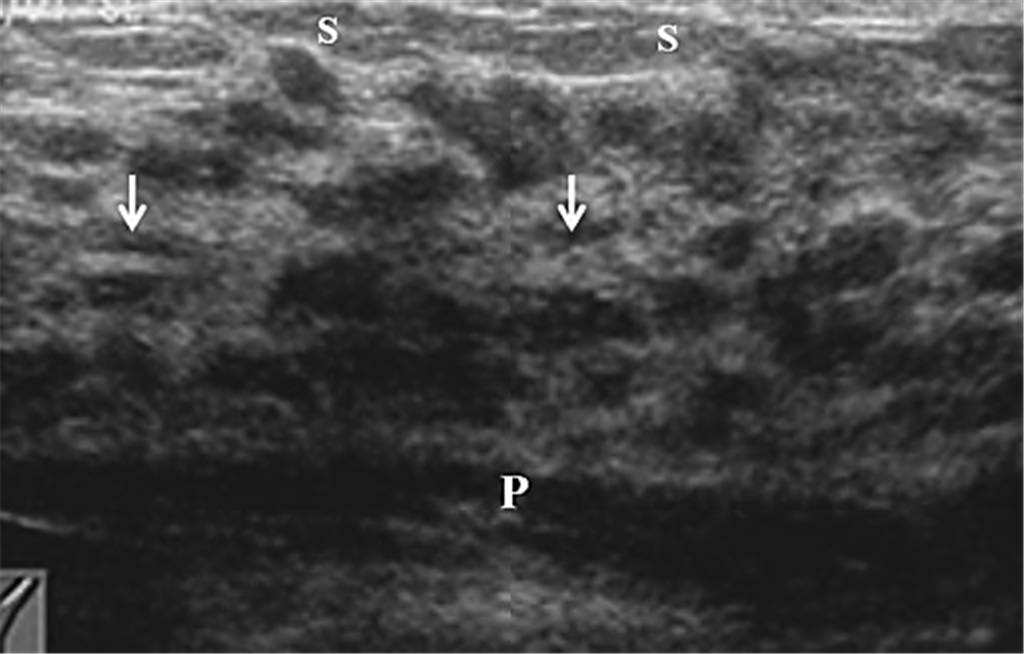 青春期乳腺发育的Tanner五阶段_导管_结缔组织_乳晕
