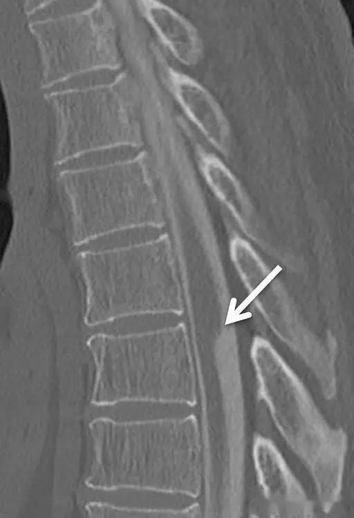 手术刀征：背侧蛛网膜网带_the_cord_of
