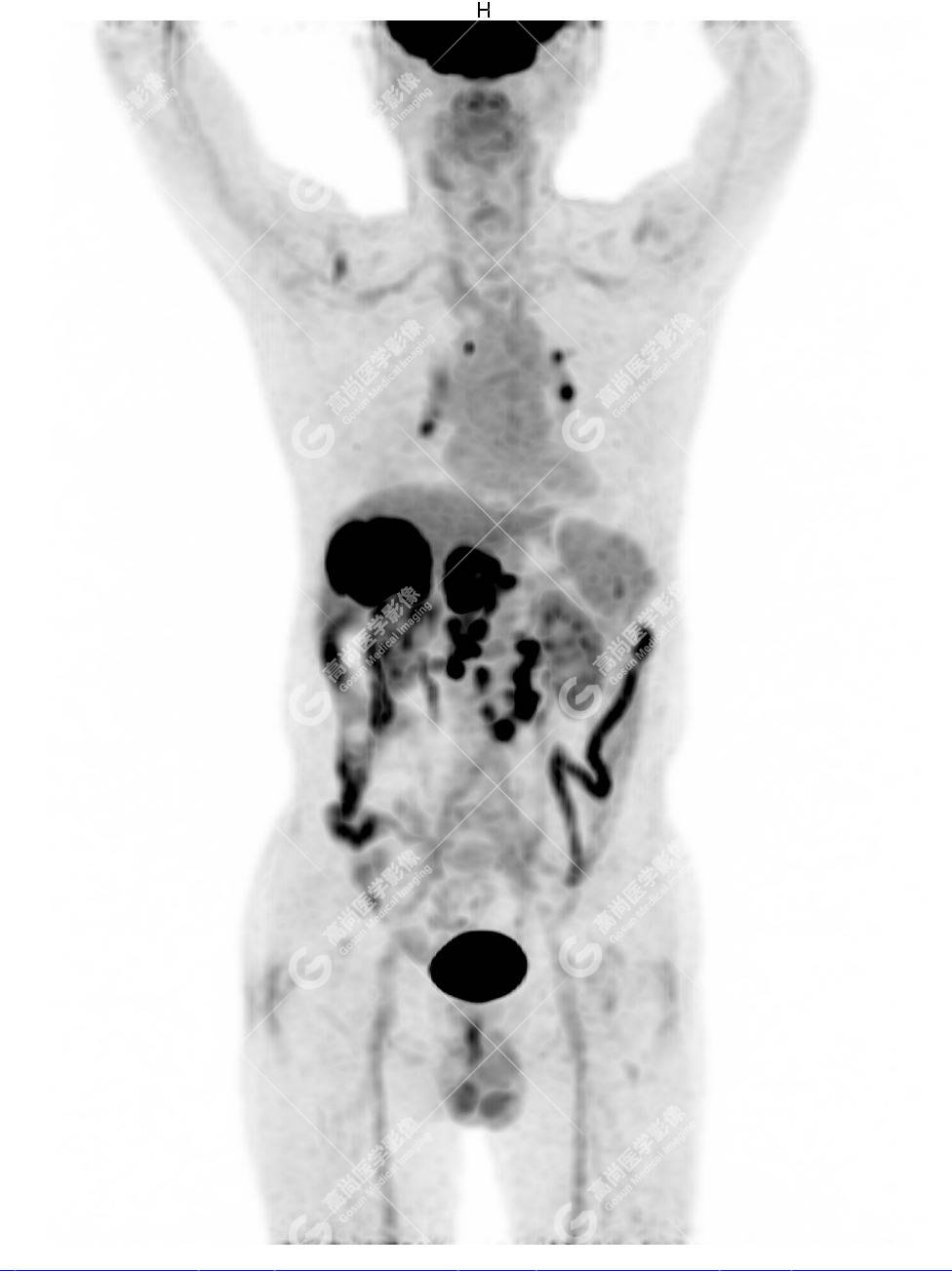 体重骤降6斤，PET/CT诊断胆管癌，一种被低估的恶性肿瘤_患者_肝脏_检查
