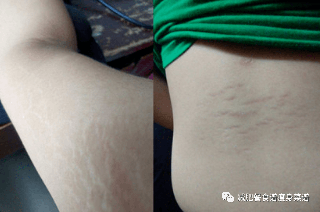 如何阻止肥胖纹与生长纹的生长?减肥脂肪身体