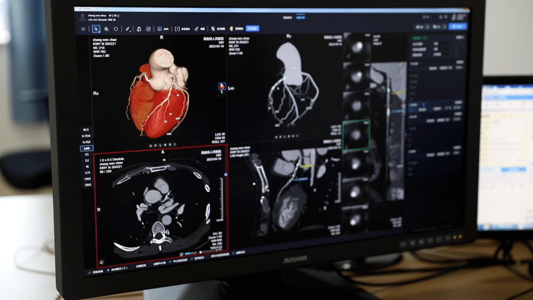 一文读懂冠脉CTA检查_诊断_患者_医生