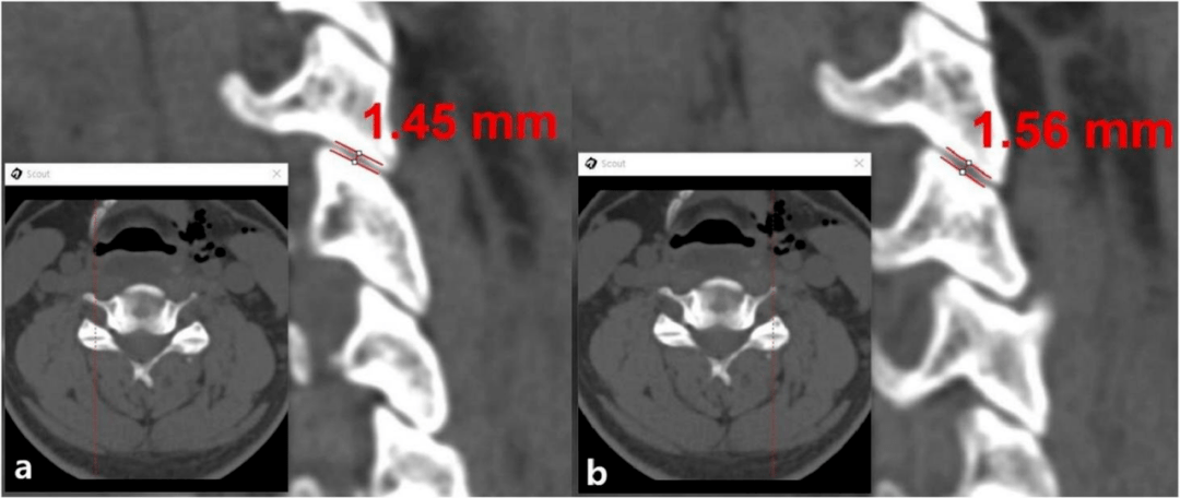 【精选编译】应用CT评估ACDF术后小关节牵张与临床预后的关系_测量_评分_牵引