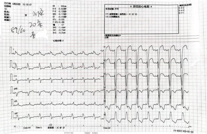 “贞”心一“课”｜ECMO辅助下TAVR治疗外科高危重度主动脉瓣狭窄1例_患者_mmHg_手术