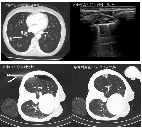 吉大一院超声诊断中心—腹部超声科完成2例CT+超声联合引导肺占位性病变穿刺活检_患者_治疗_放射线